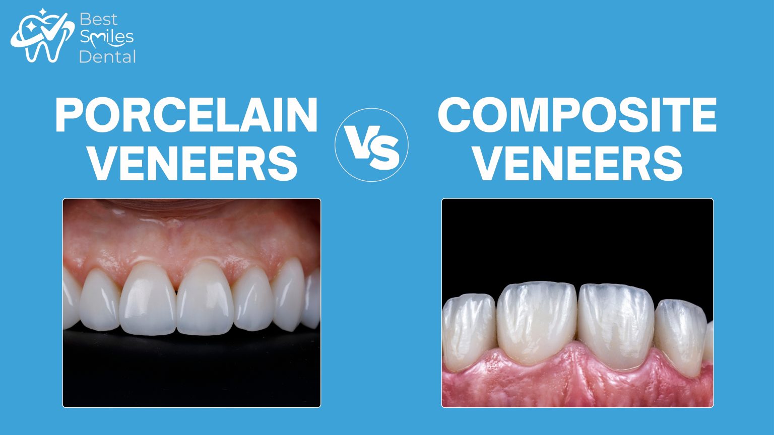 Porcelain vs. Composite Veneers: Which is the Better Choice?