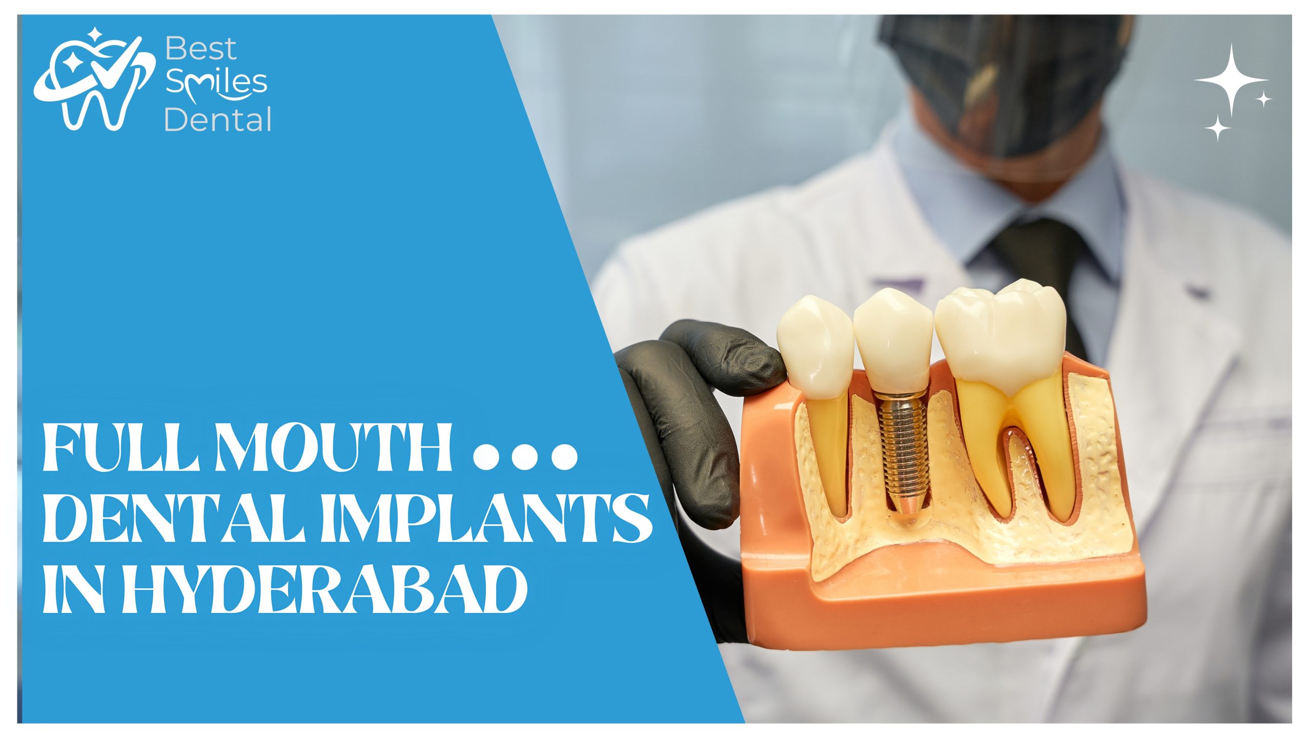 Full Mouth Dental Implants in Hyderabad - Best Smiles Dental