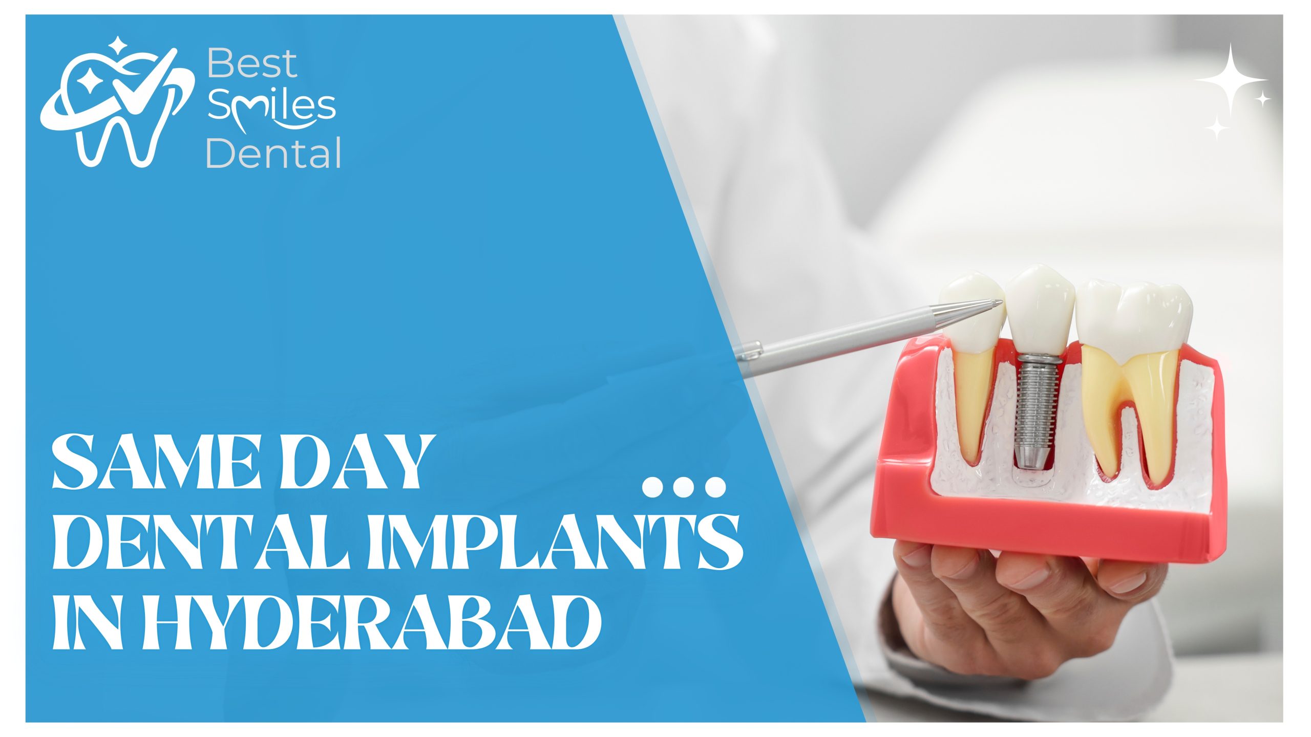 Same Day Dental Implants in Hyderabad - Best Smiles Dental