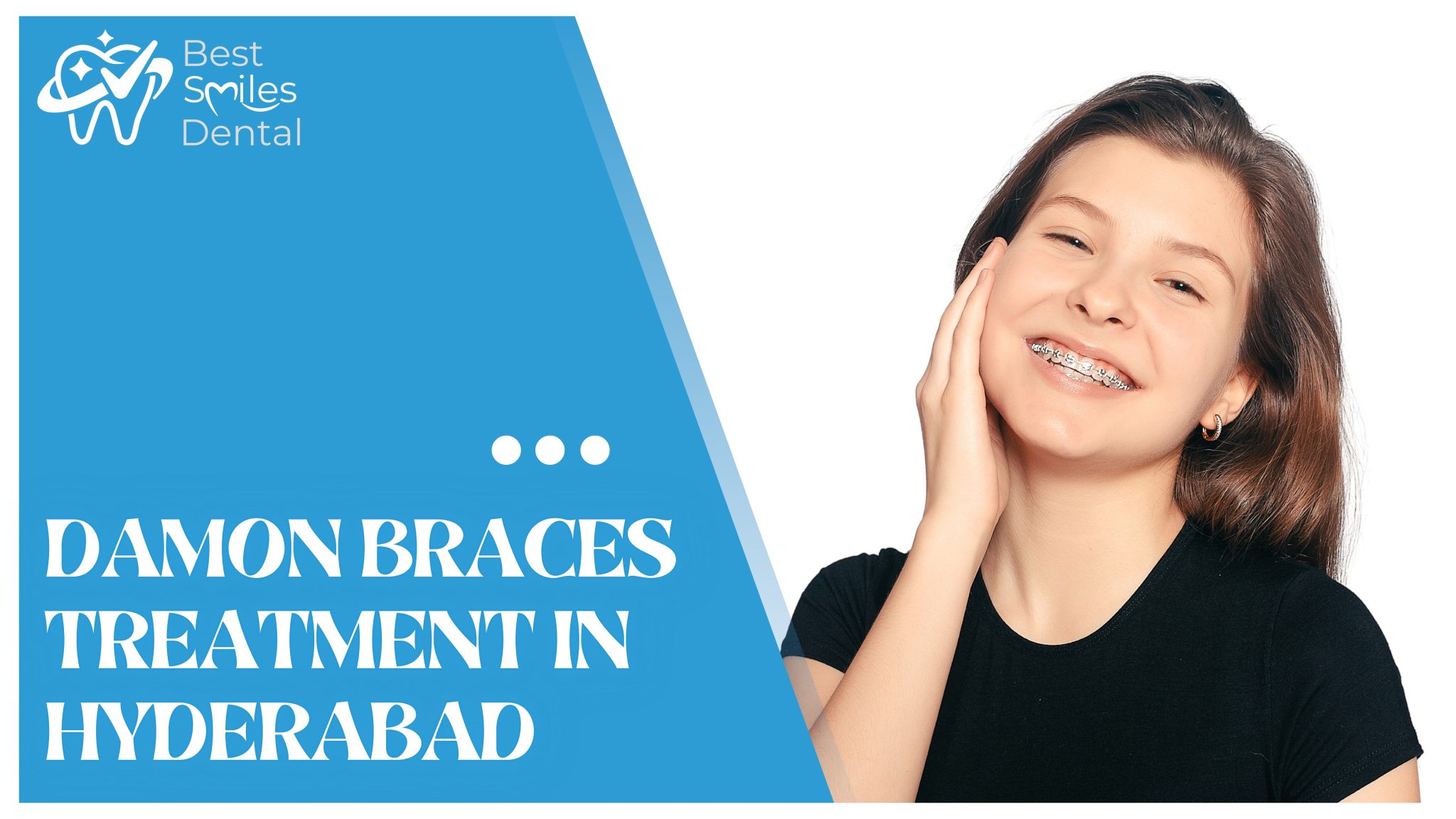Damon Braces for Adults: It’s Not Too Late for That Perfect Smile