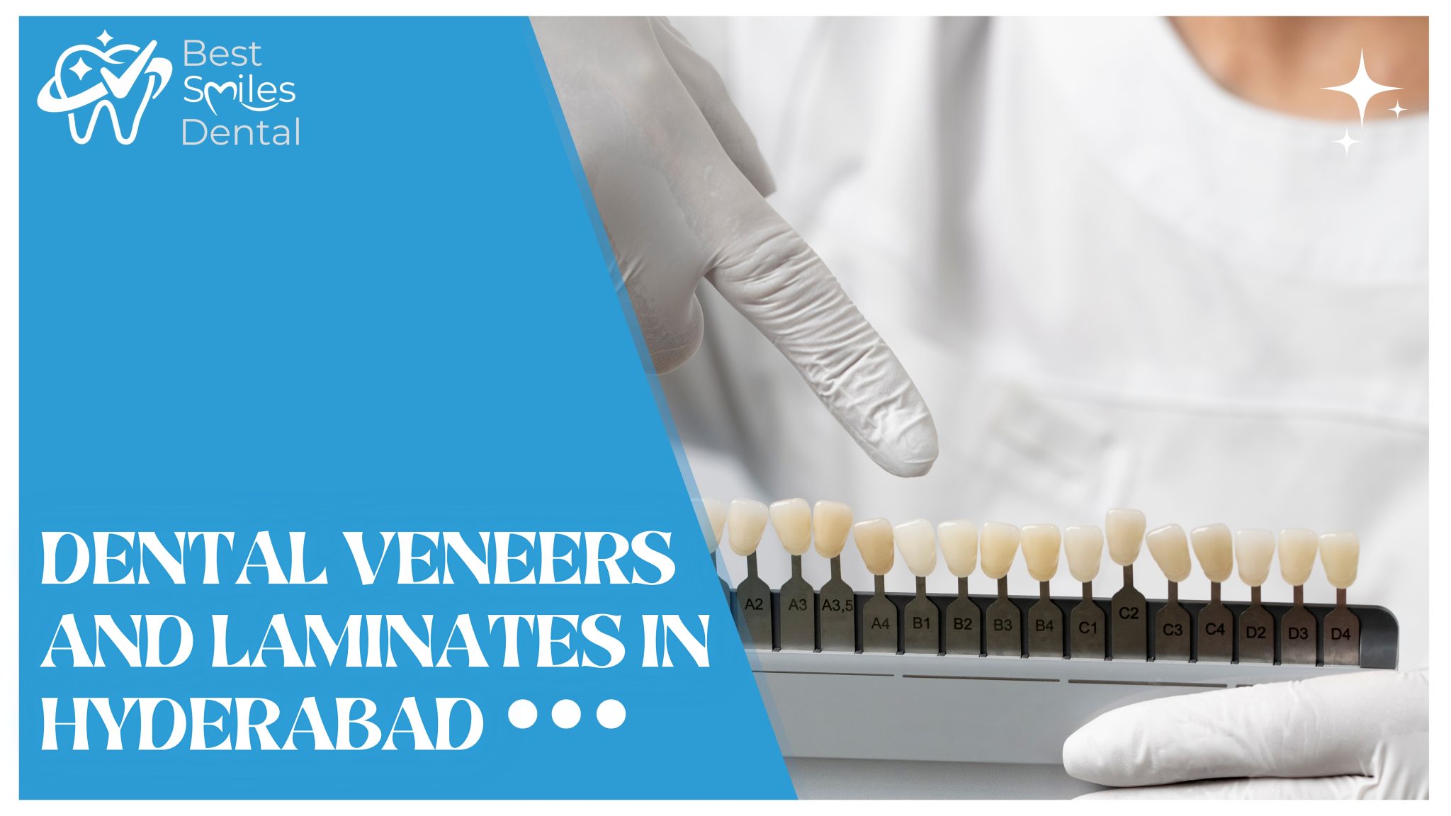 Dental Veneers and Laminates: Types, Cost, and After-Treatment Tips