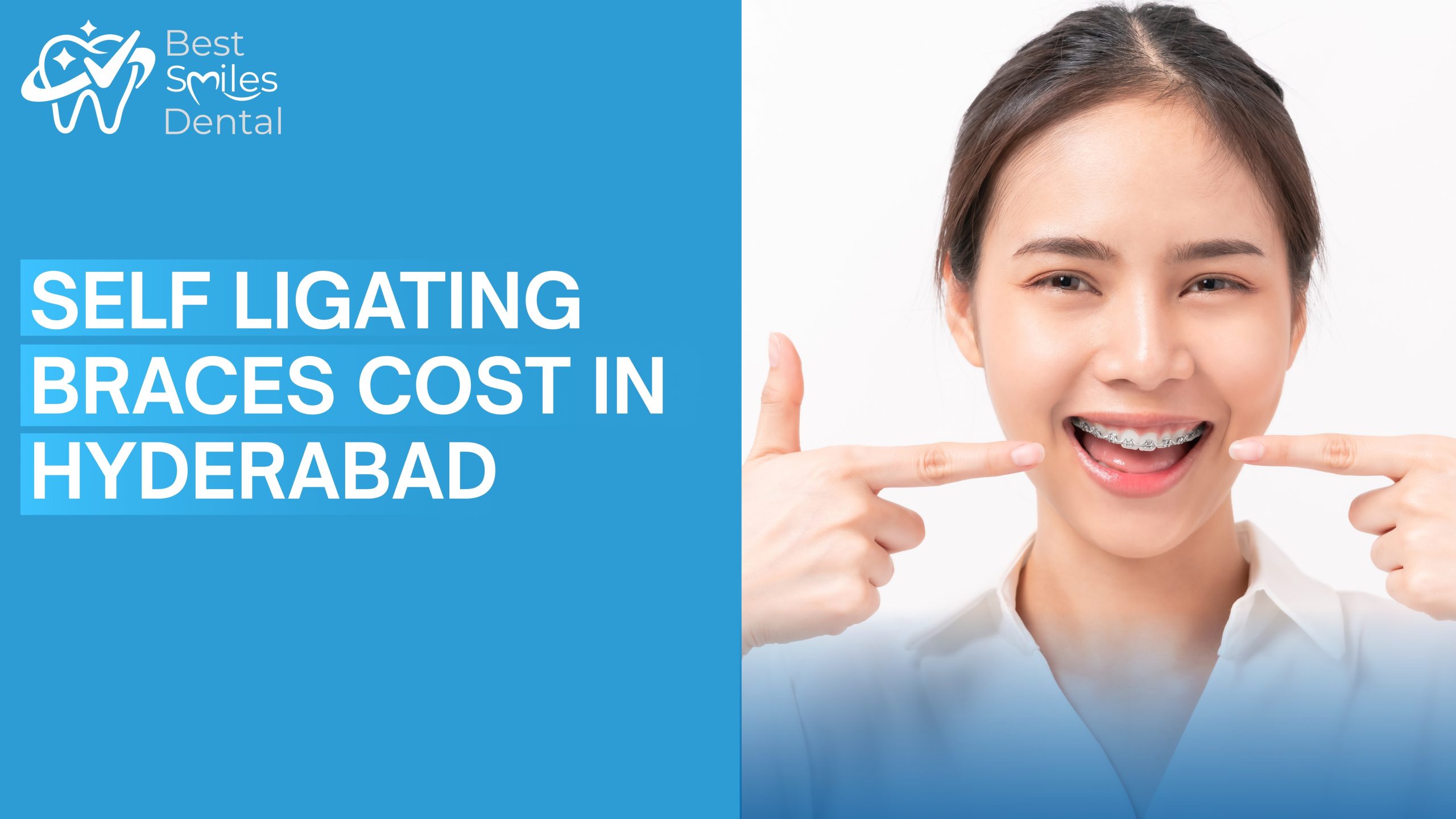 Self-Ligating Braces Cost in Hyderabad | Types & Benefits