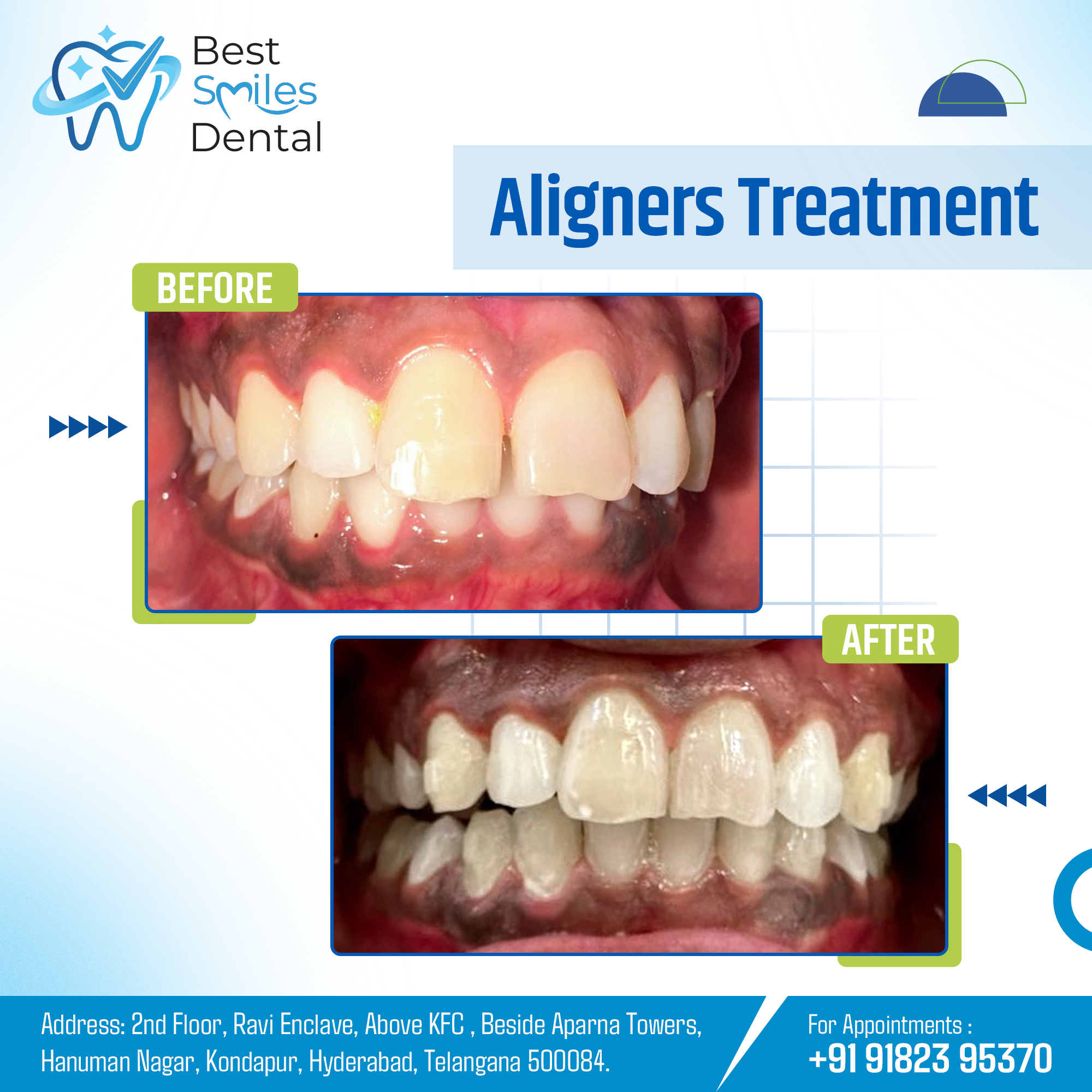Looking for the Best Invisalign Dental Clinic in Hyderabad? Choose Best ...