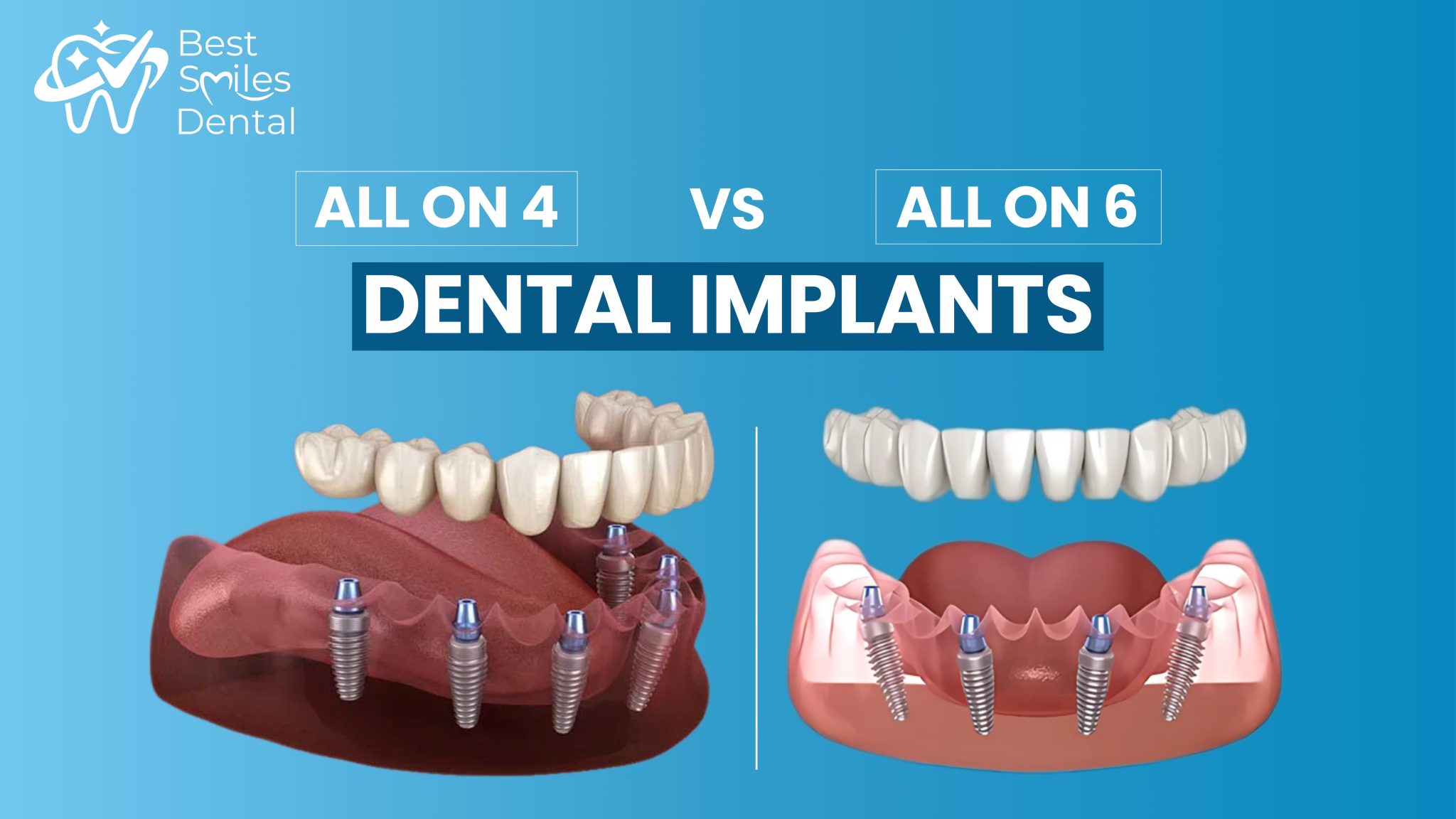 Everything You Need to Know About All-on-4 vs All-on-6 Dental Implants