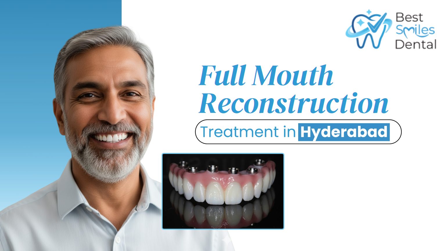 Full Mouth Reconstruction Treatment in Hyderabad