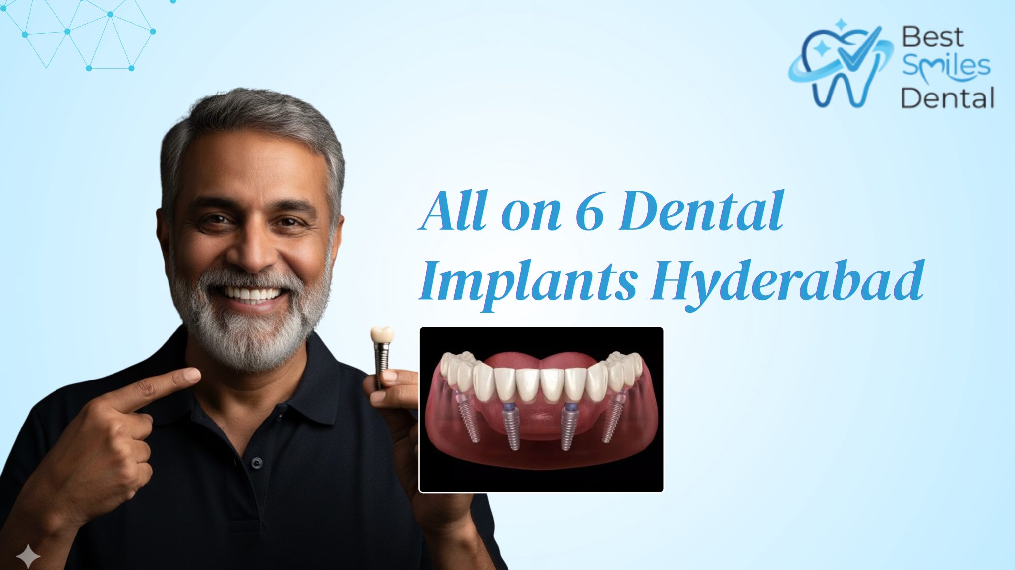 All on 6 Dental Implants for Full Mouth Restoration in Hyderabad