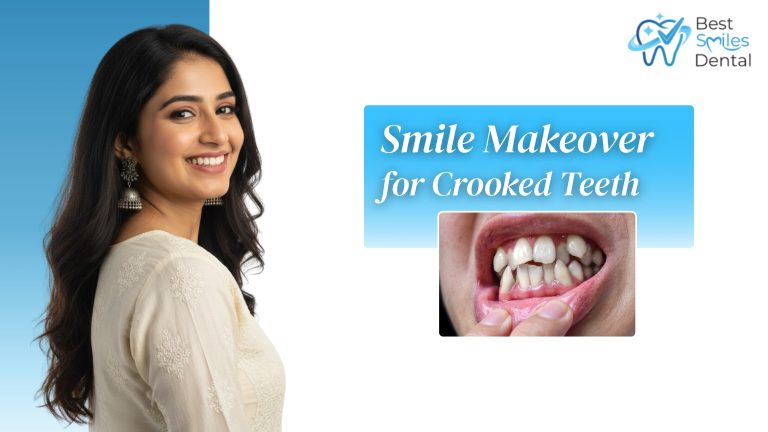 Smile Makeover for Crooked Teeth
