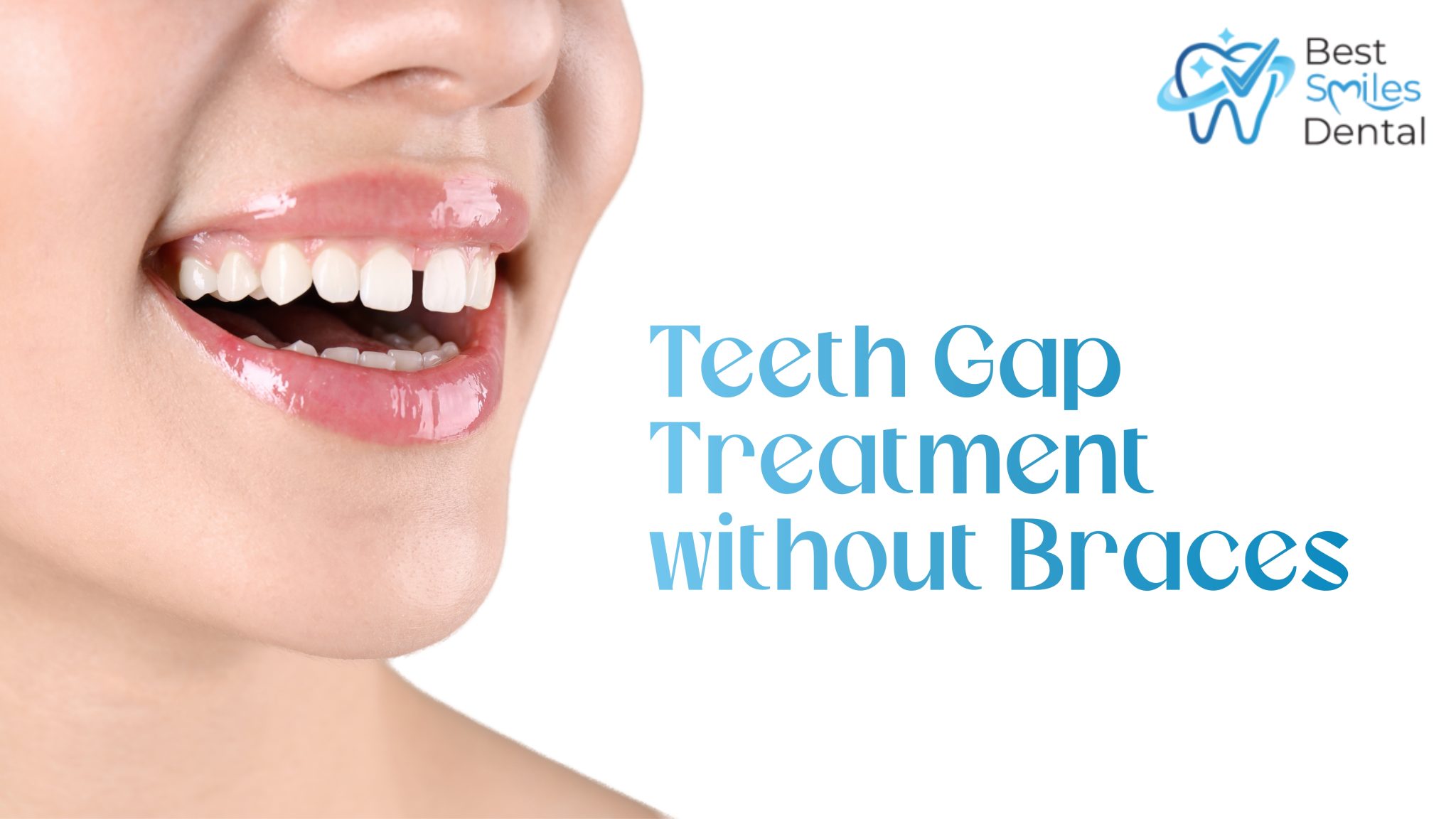 Teeth Gap Treatment Without Braces in Hyderabad: Modern, Painless Solutions